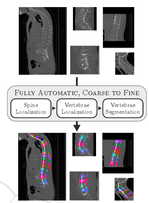 Coarse to Fine Vertebrae Localization and Segmentation with SpatialConfiguration-Net and U-Net - 知乎