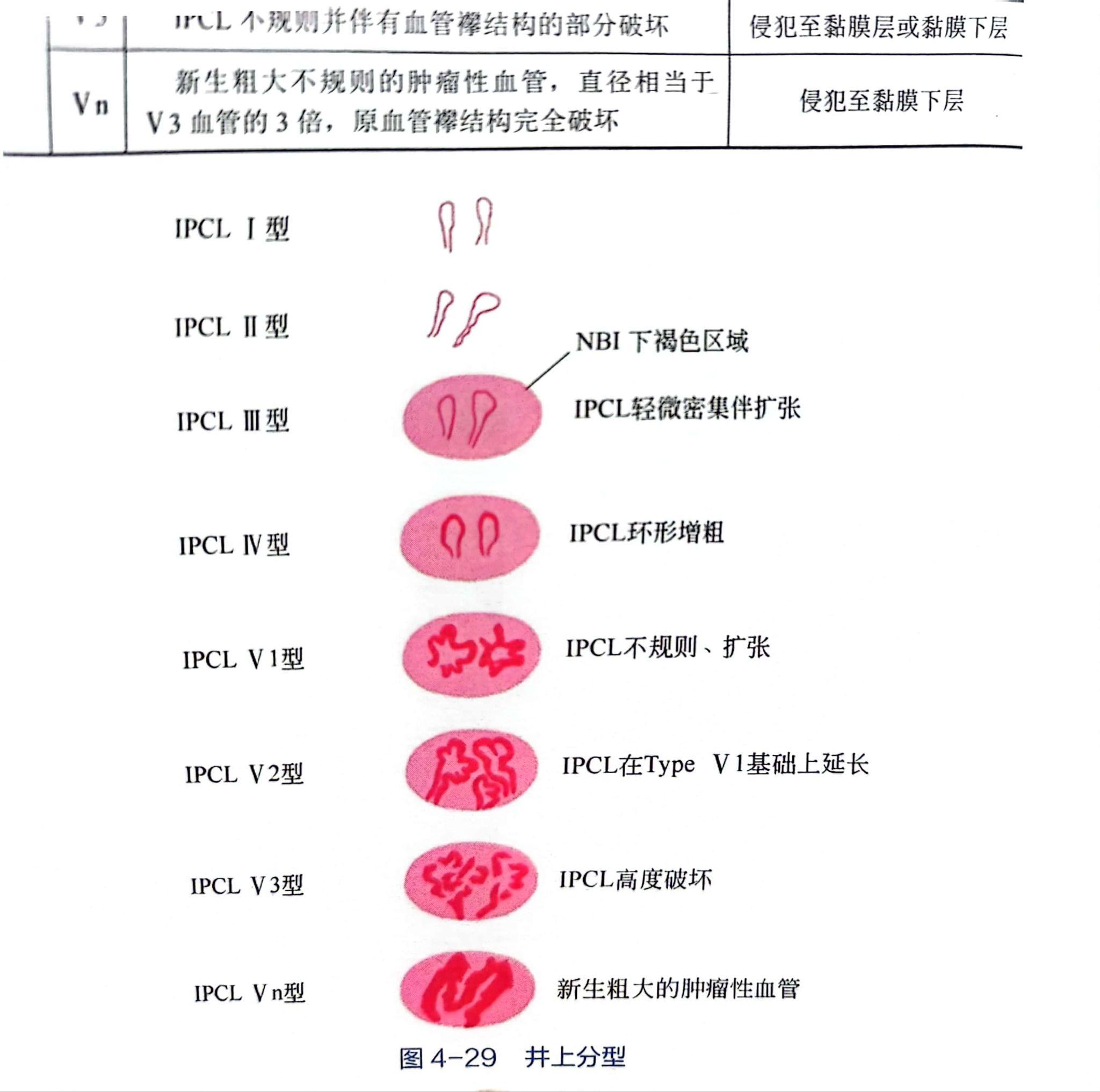 在NBI模式下放大内镜-观察上皮乳头内毛细血管袢（IPCL）图像表现及临床意义 - 知乎