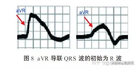 宽QRS波心动过速的鉴别诊断 - 知乎
