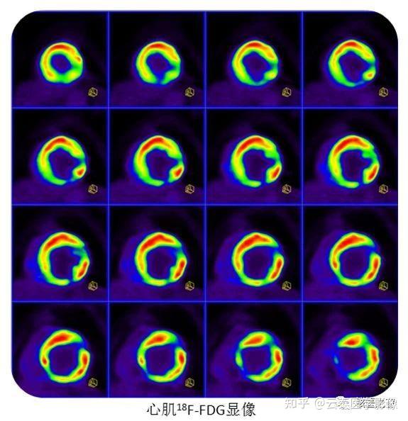 PET/CT在心血管疾病中的应用 - 知乎