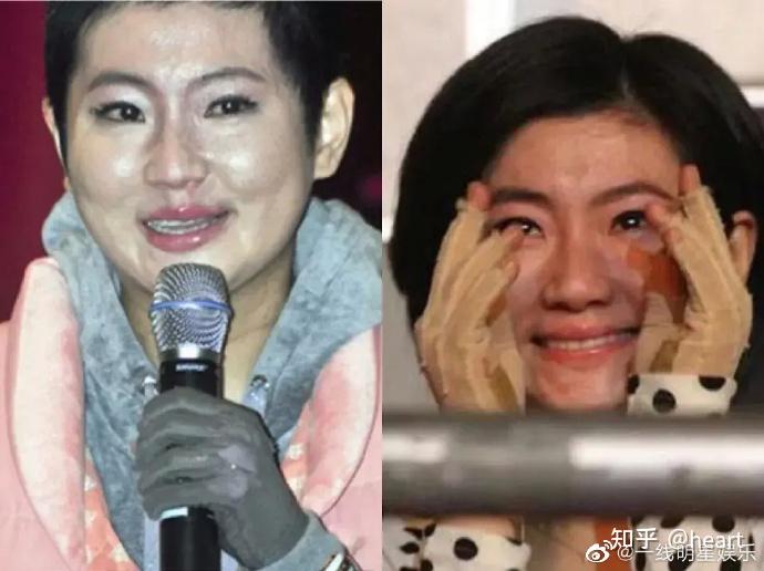 Selina首次谈烧伤后遗症，太揪心了！ - 知乎