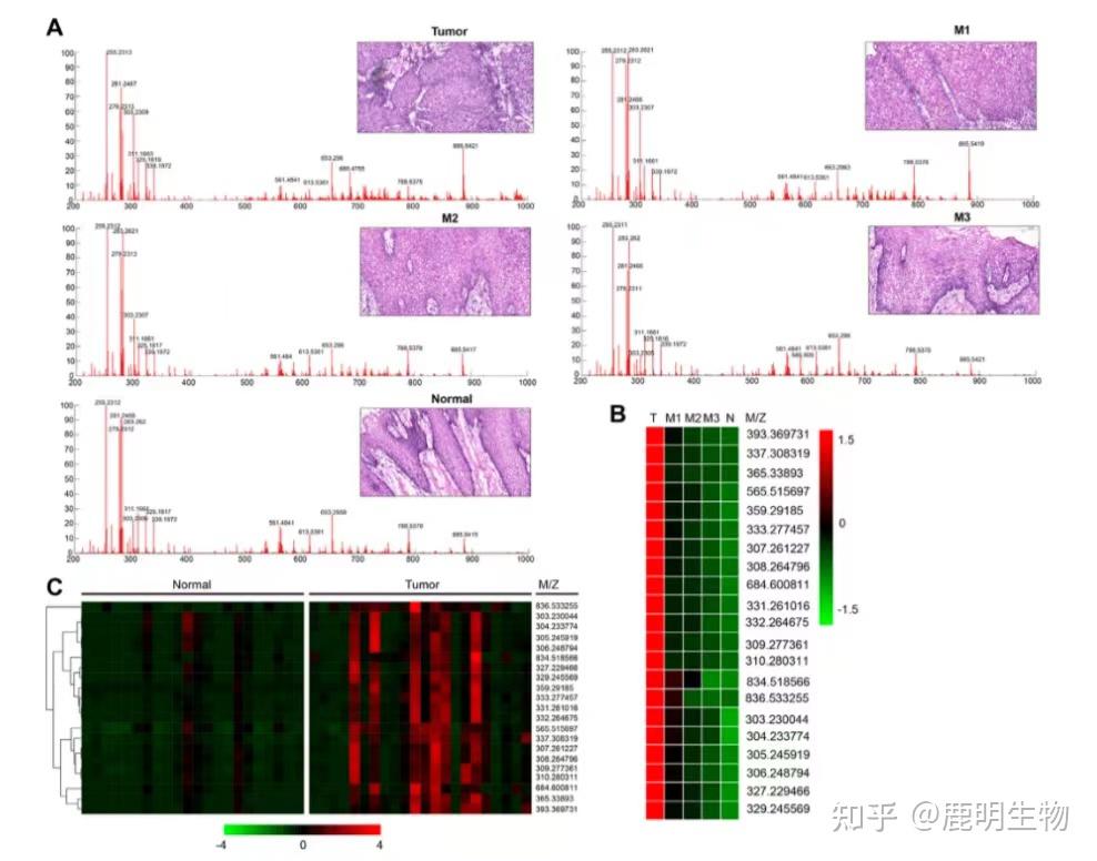空间代谢组质谱成像技术揭示口腔鳞状细胞癌手术边缘特征 - 知乎