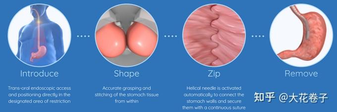 内镜袖状胃成形术自动缝合器 - 知乎