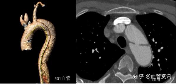 WeFlow-Tbranch单内嵌分支胸主动脉覆膜支架系统临床试验随访结果 - 知乎