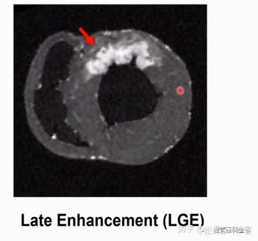 心脏磁共振扫描——EGE - 知乎