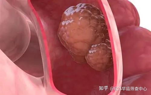 还在把直肠癌当成痔疮吗?了解这些症状,别再酿成大错! 知乎