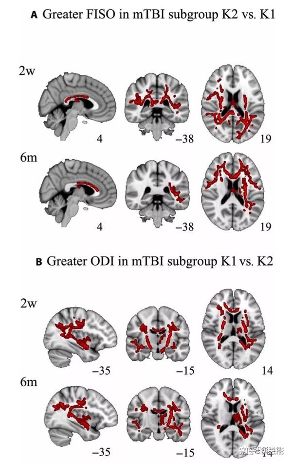 Science子刊：利用DTI和NODDI纵向研究揭示轻度脑外伤后的白质微结构改变 - 知乎