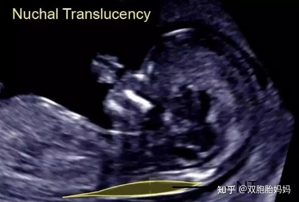 掌握基本功！一看就懂的NT测量常用解读方法，图文并茂 - 知乎