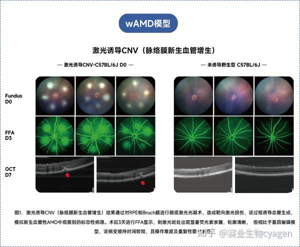 被岁月偷走的视力——年龄相关性黄斑变性 - 知乎
