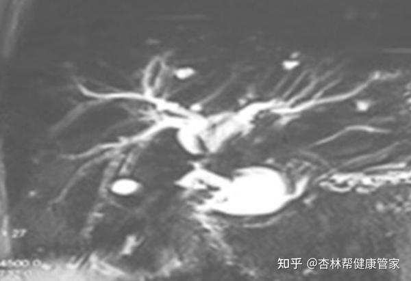 MRCP的科普 - 知乎