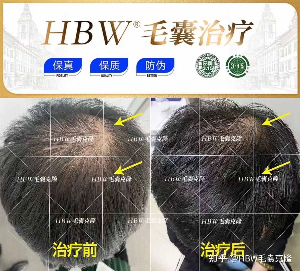 HBW毛囊治疗 - 知乎