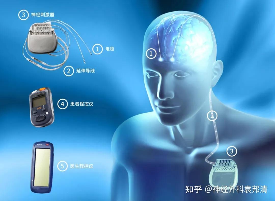 DBS手术流程详解，一文带你浏览全程 - 知乎