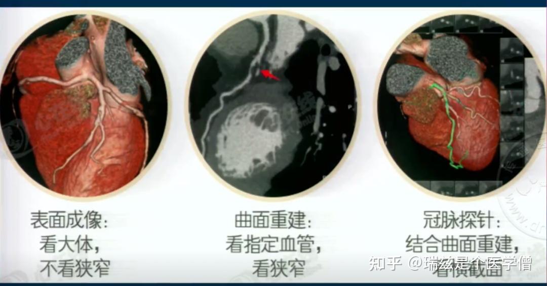 手把手教你读懂冠脉CTA - 知乎