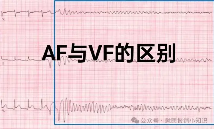 AF与VF的区别 - 知乎