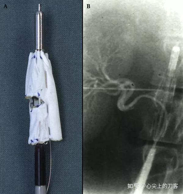 重读经典 | EVAR的今身 - 知乎