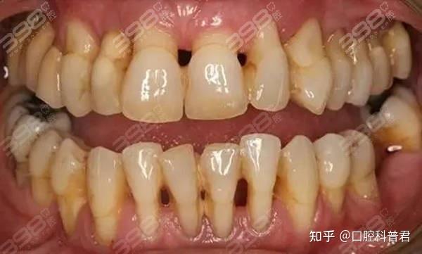 中年人牙龈萎缩怎么恢复?不同原因导致的萎缩恢复方式不同 知乎