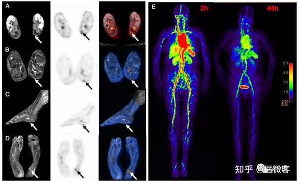 以124I-JS001为示踪剂的PET/MR显像在无创筛选肿瘤免疫治疗获益人群中的重要价值 - 知乎