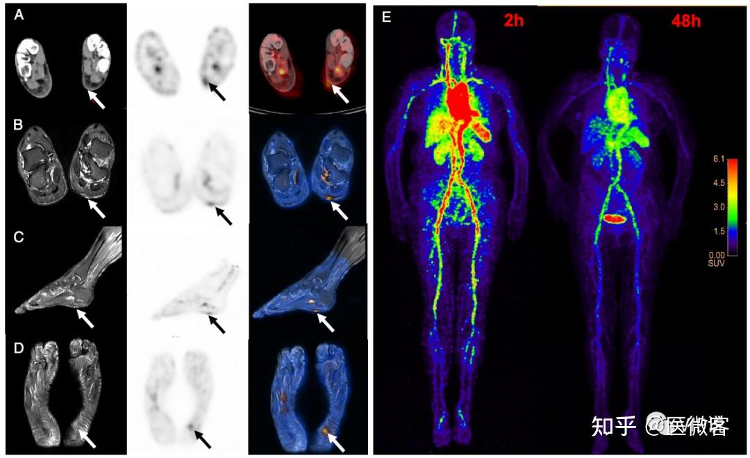 以124I-JS001为示踪剂的PET/MR显像在无创筛选肿瘤免疫治疗获益人群中的重要价值 - 知乎