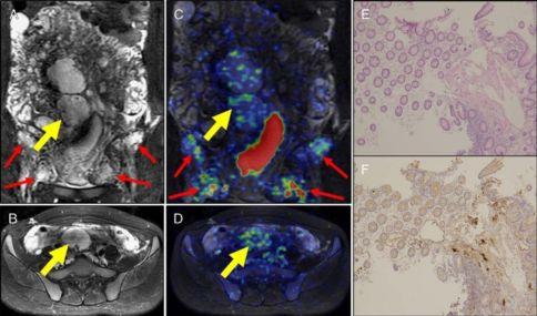 淋巴管瘤在68Ga-NOTA-Evans Blue PET/MRI上的表现 - 知乎