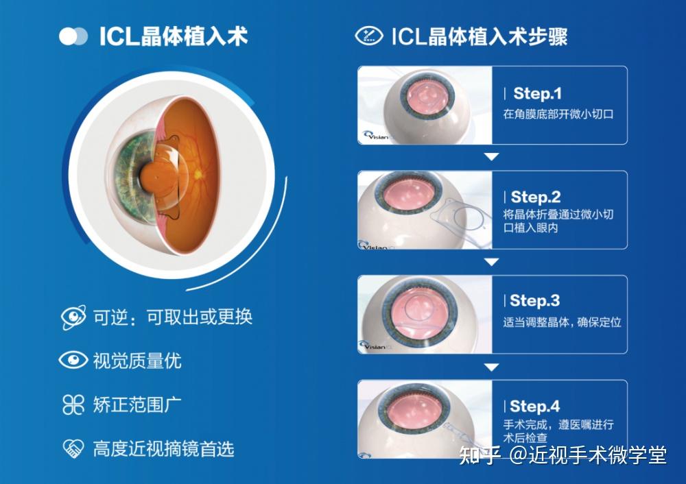 一文讲解清楚：ICL晶体植入近视手术矫正高度近视全攻略 - 知乎