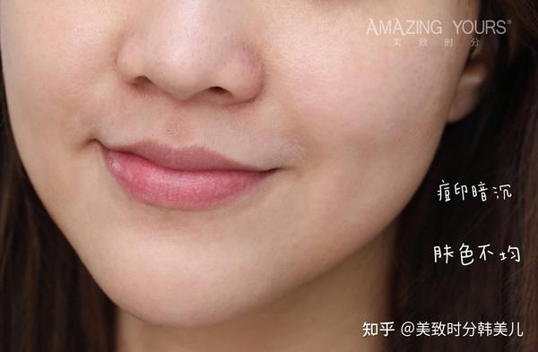 唇周肌肤三大问题美致时分 知乎