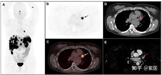 68Ga-DOTATOC PET：探索心肌世界的新视角 - 知乎