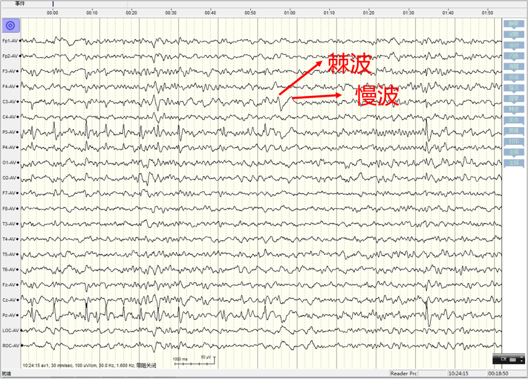癫痫诊疗的“秘密武器” - 知乎