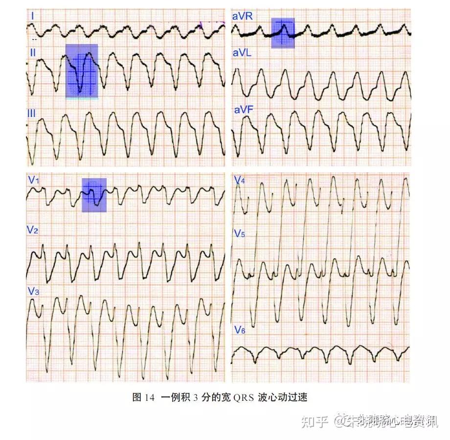 宽QRS波心动过速的鉴别诊断 - 知乎