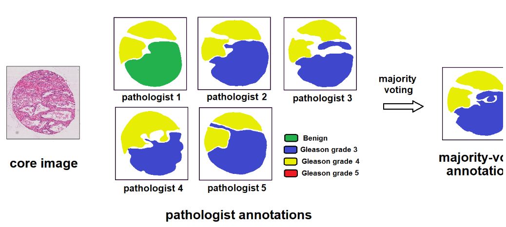 Gleason 2019 数据集介绍 - 知乎