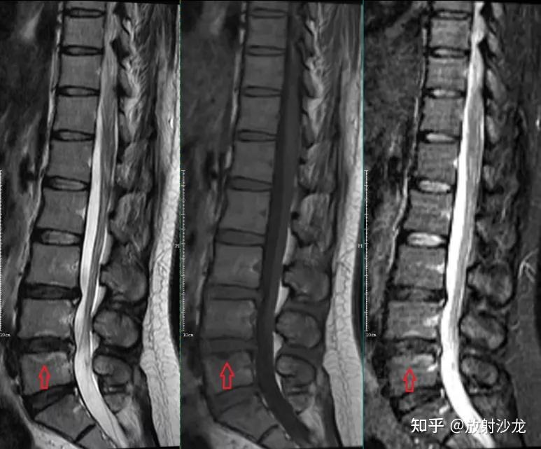 椎体终板炎 | 发生机制、分型以及 MRI 表现 - 知乎