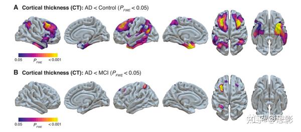 轻度认知障碍与阿尔茨海默病痴呆中皮质微结构改变 - 知乎