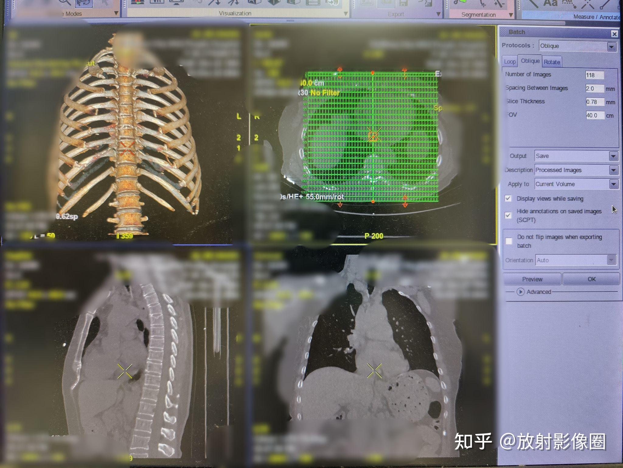 浅谈CT三维重建的操作方法 - 知乎