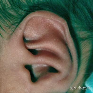Conchal Crus 耳(耳廓形态) - 知乎