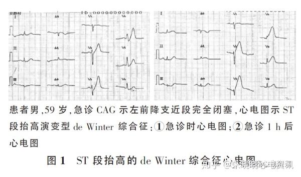 de Winter 综合征临床资料分析 - 知乎