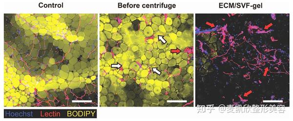 2021年SVF-GEL 南方医院学术会议笔记 - 知乎
