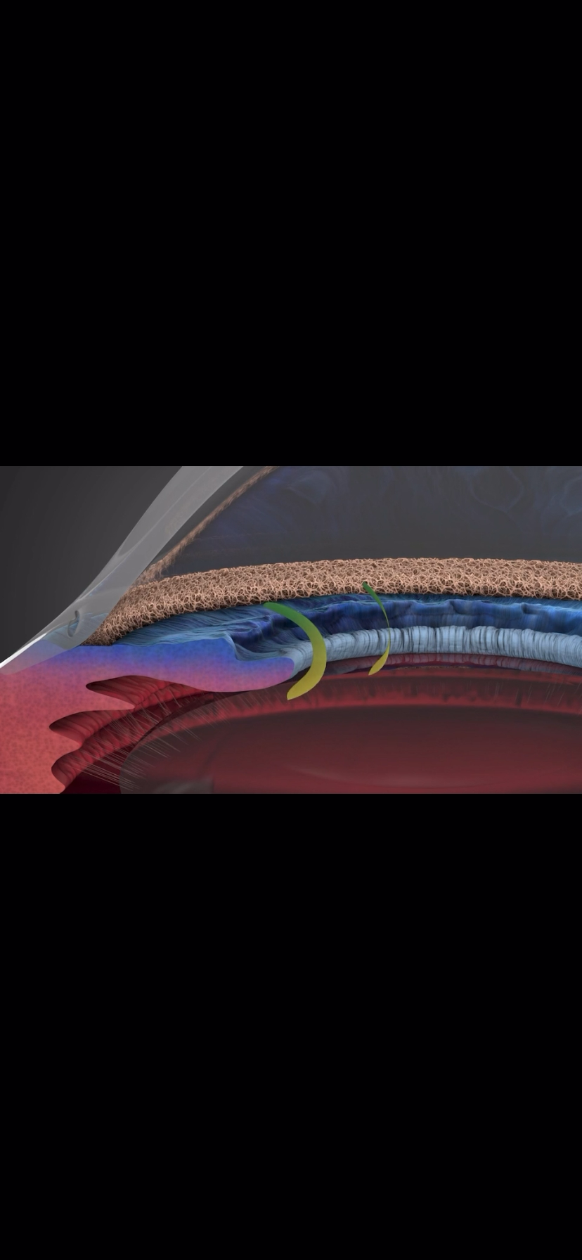 带你了解ELIOS 准分子激光小梁造瘘术 - 知乎