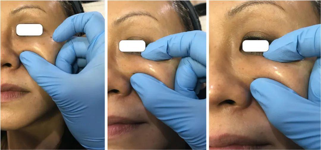 面部过度填充综合症（FOS） - 知乎