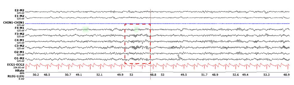 正常睡眠的分期和结构 - 知乎