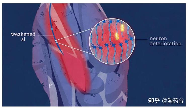 脊髓性肌萎缩症(SMA)口服药Evrysdi（risdiplam）最新FDA 批准 - 知乎