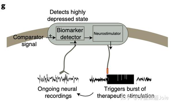 【THERAPY】Closed-loop neuromodulation in an individual with treatment-resistant depression - 知乎
