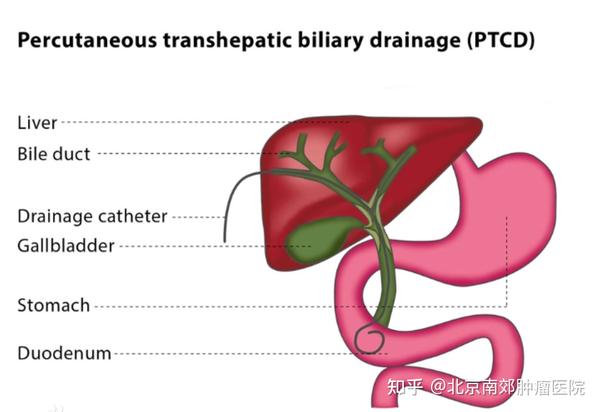 【胆道疾病患者的福音】经皮肝穿刺胆道引流术(PTCD） - 知乎