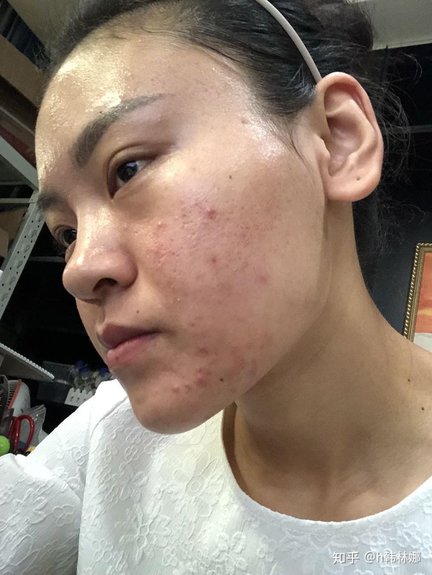 祛痘历程 知乎