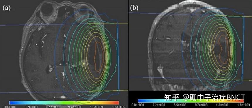BNCT治疗复发性GBM的个案报道 - 知乎