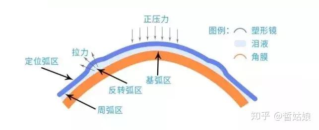 晚上佩戴8小时白天可暂时恢复清晰视力！OK镜是怎么做到的？ - 知乎
