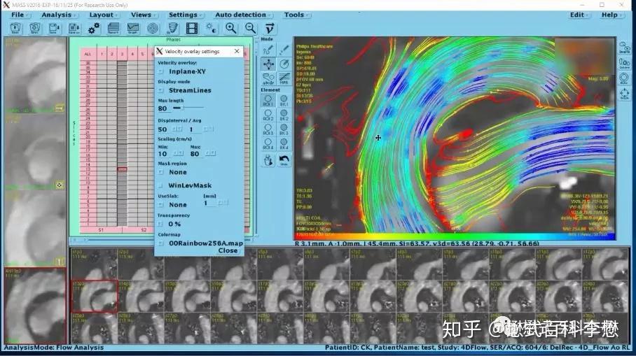 心脏磁共振技术大全（四） - 知乎