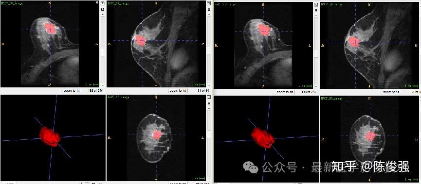 MAMA-MIA2025——乳腺 MRI 肿瘤分割和治疗反应预测 - 知乎