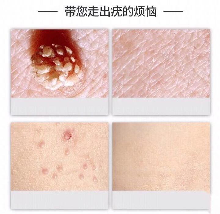 尖锐湿疣最好的方法!教你用好!正确使用方式及其他方法的介绍。 知乎