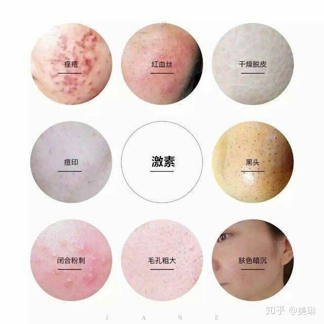 2020年最具体点的激素脸的最佳治疗方法 一荣美肤老师 知乎