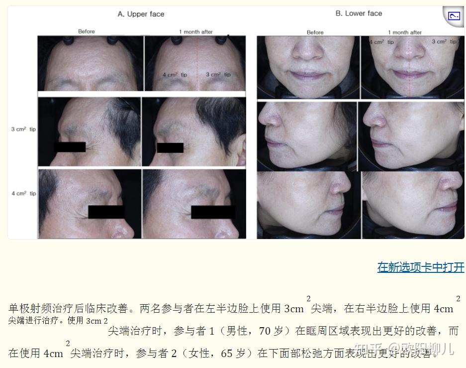 5代热玛吉FLX相比4代热玛吉CPT有哪些技术升级，在疗效上有哪些提升？ - 知乎