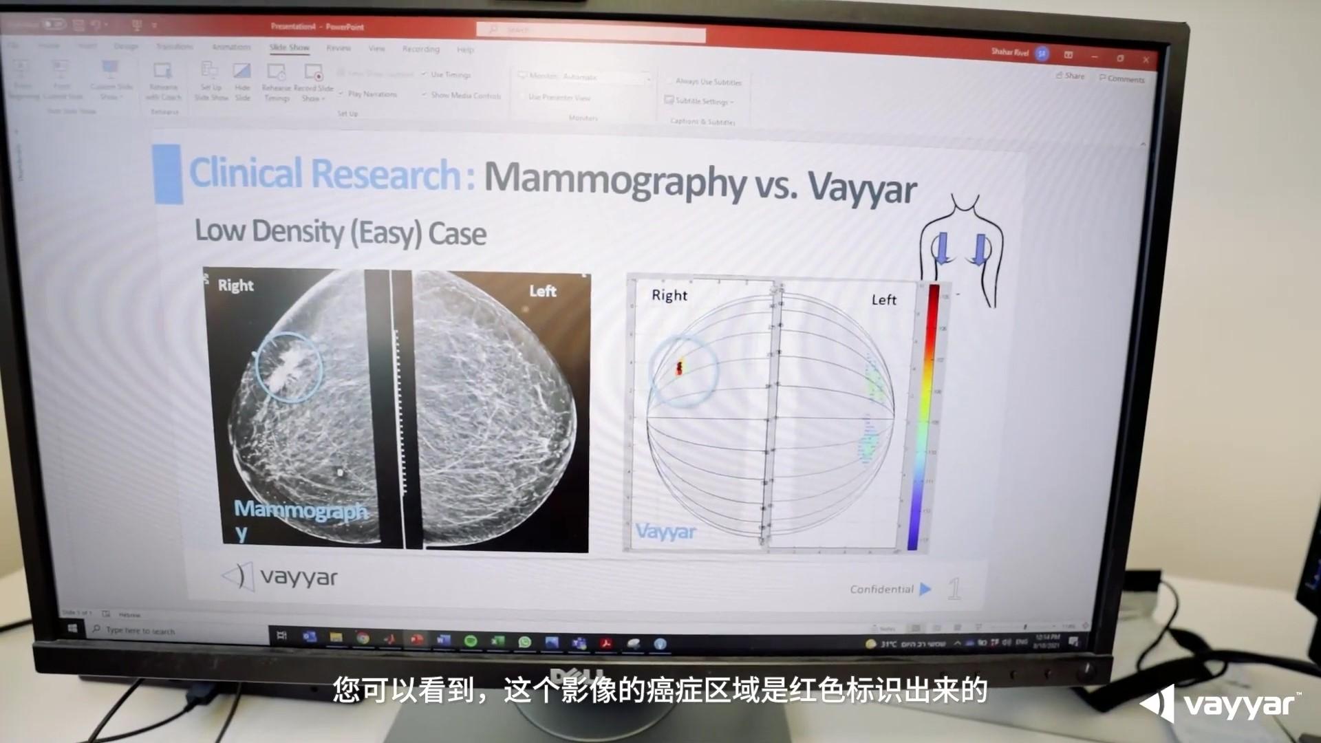 走进Vayyar毫米波射频成像时代（三）| 手持乳腺癌筛查解决方案，为女性健康保驾护航 - 知乎